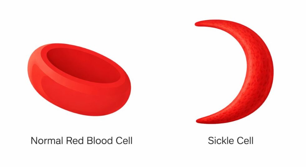 RLE Surgery and Sickle Cell Disease (Guide)